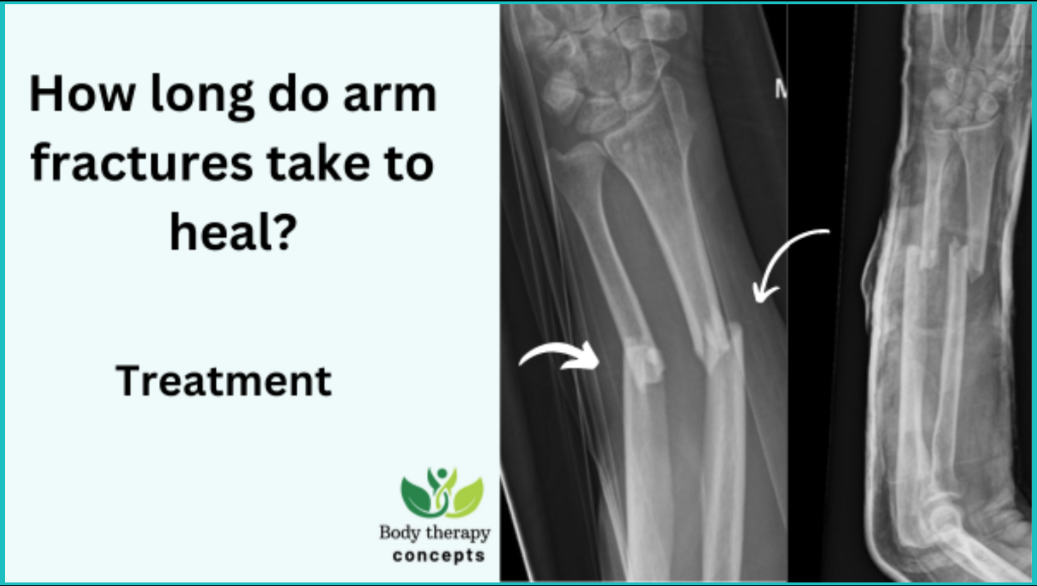Forearm fractures in Adults: Treatment and recovery tips: what you need ...