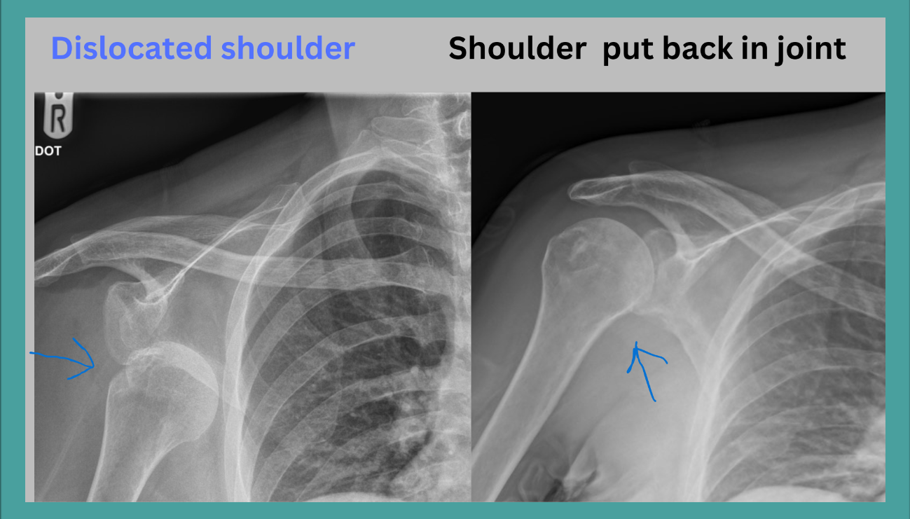 How long does it take for a dislocated shoulder to heal?