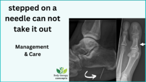 Foreign sharp object in the foot: First aid and management.