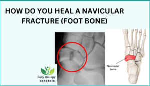 How do you heal a navicular fracture (foot bone)